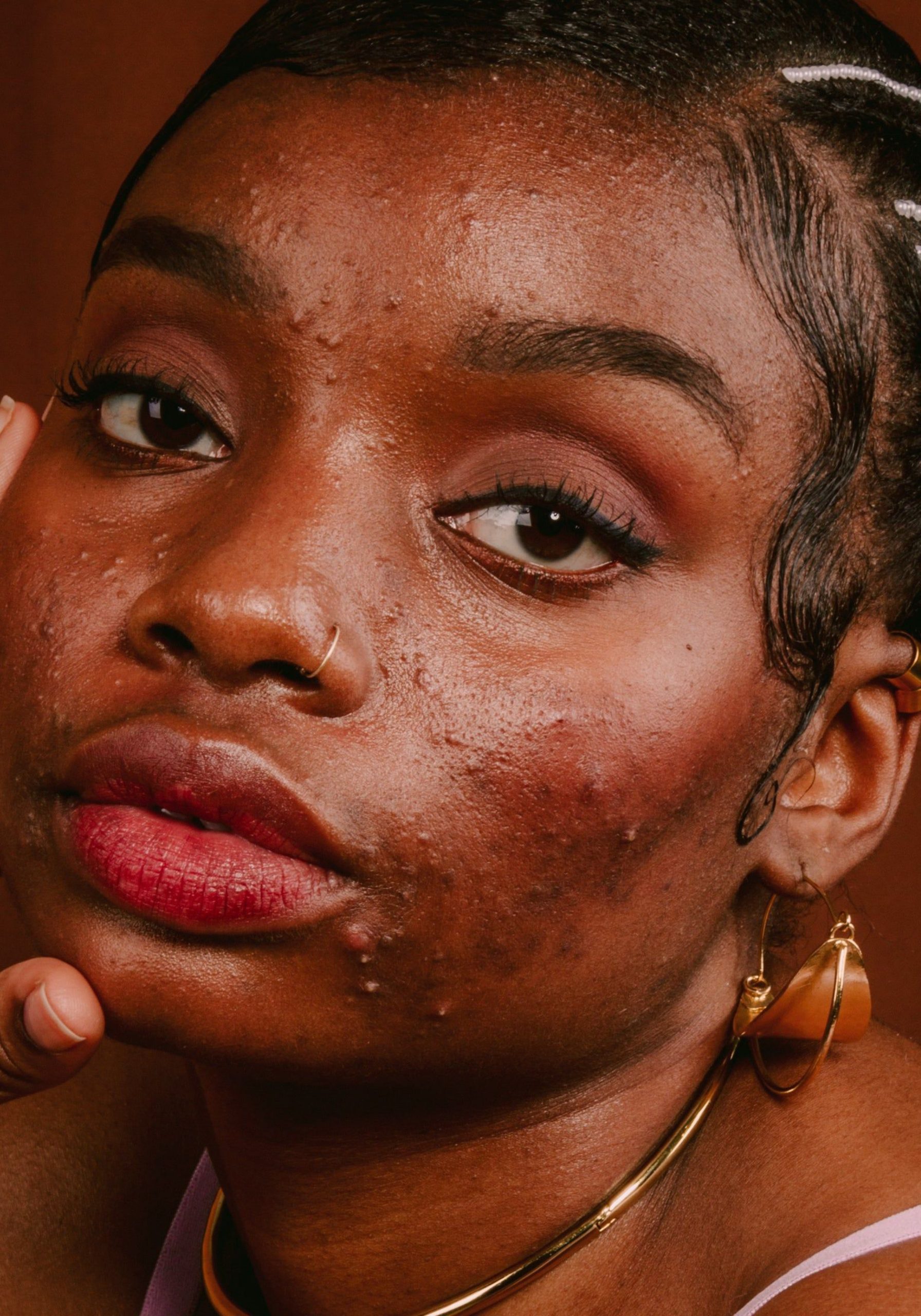 9 Mistakes You Must Avoid While Concealing Pimples - TheWill Downtown